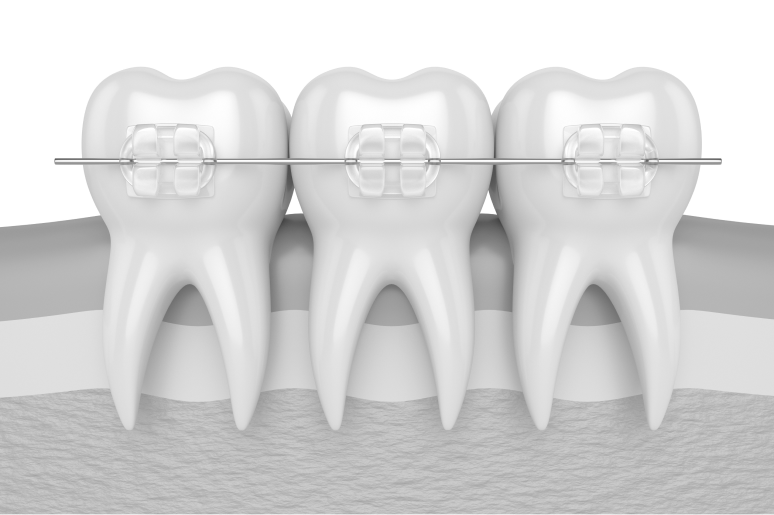 Braces (Conventional & Invisalign) - K Family Dental